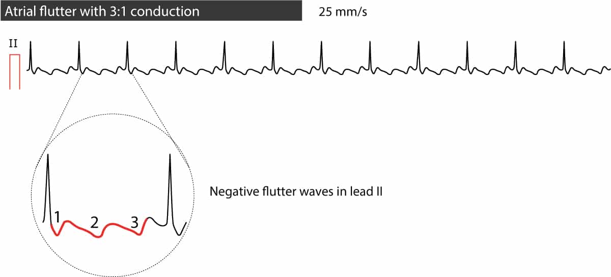 Atrial flutter – The Cardiovascular