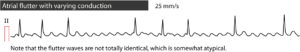 Atrial flutter: classification, causes, ECG diagnosis & management
