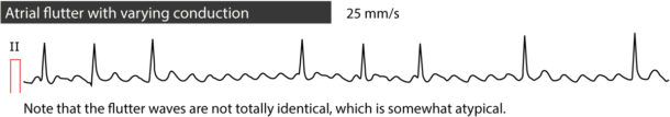 Atrial flutter: classification, causes, ECG diagnosis & management