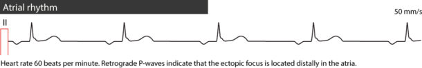 Ectopic atrial rhythm (EAT), atrial tachycardia (AT) & multifocal ...