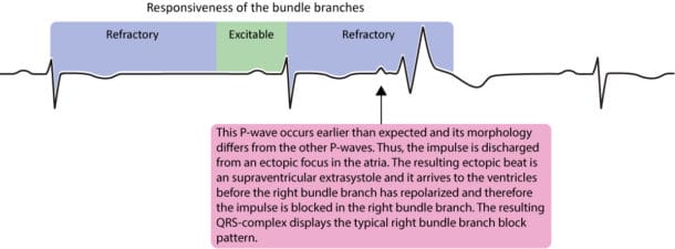 Aberrant ventricular conduction (aberrancy, aberration)