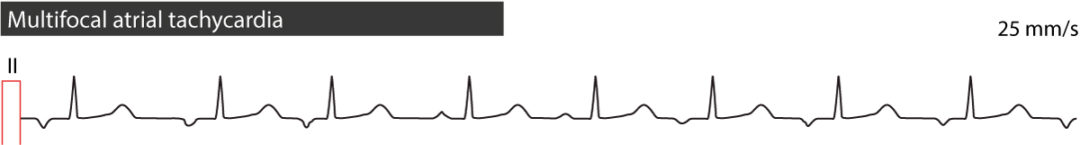 Ectopic atrial rhythm (EAT), atrial tachycardia (AT) & multifocal ...