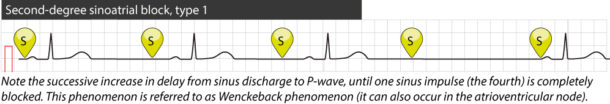 Sinoatrial block (SA block): ECG criteria, causes and clinical features