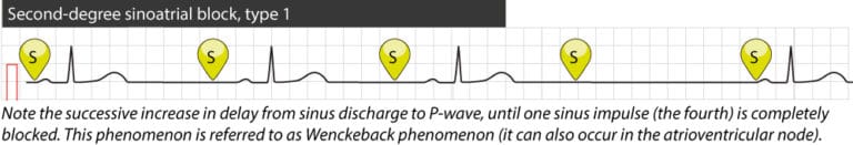 Sinoatrial block (SA block): ECG criteria, causes and clinical features