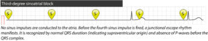 Sinoatrial block (SA block): ECG criteria, causes and clinical features
