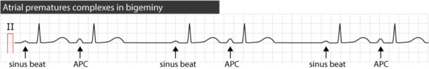 Premature atrial contraction (premature atrial beat / complex): ECG ...