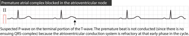 Premature atrial contraction (premature atrial beat / complex): ECG ...
