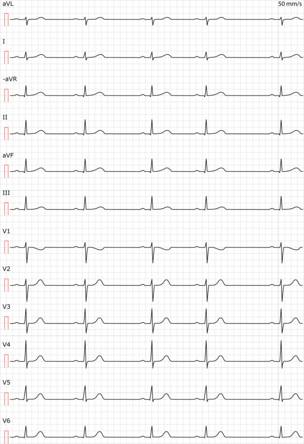 Figure 1. Sinus arrhythmia (respiratory sinus arrhythmia). – The ...
