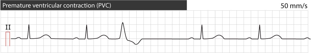 Premature ventricular contraction (ventricular extrasystole) – The ...