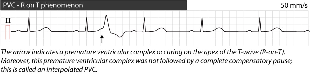 Premature ventricular beat with R on T – The Cardiovascular