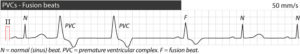 Premature ventricular contractions (premature ventricular complex ...