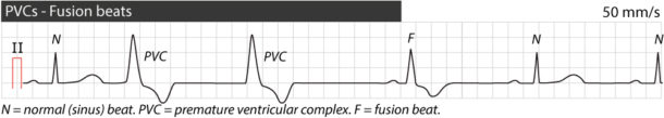Premature ventricular contractions (premature ventricular complex ...