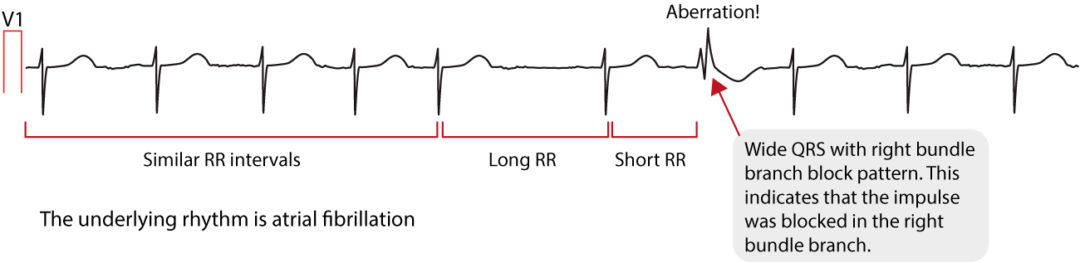 Figure 4. ECG showing Ashman’s phenomenon during atrial fibrillation ...