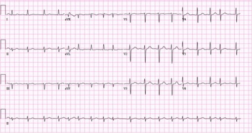 Example of 12-lead ECG with atrial fibrillation. – The Cardiovascular