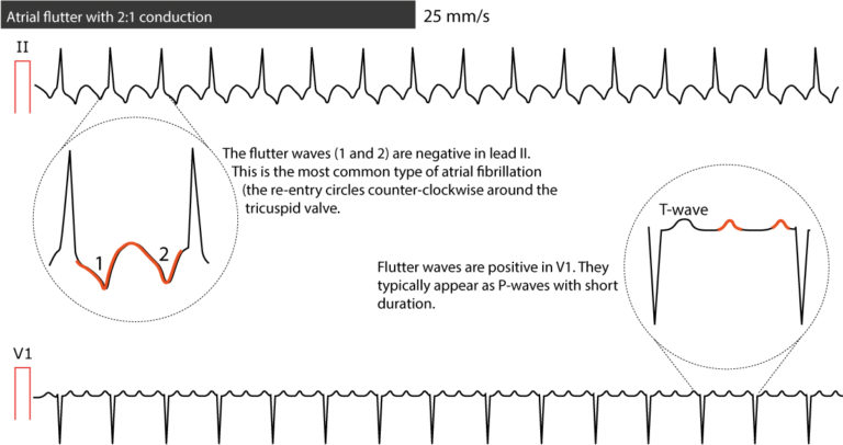 Atrial flutter: classification, causes, ECG diagnosis & management