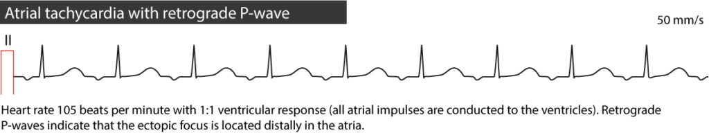 Ectopic atrial rhythm (EAT), atrial tachycardia (AT) & multifocal ...