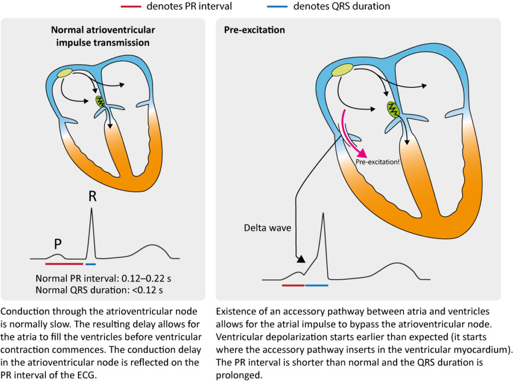 Pre-excitation, Atrioventricular Reentrant (Reentry) Tachycardia (AVRT ...