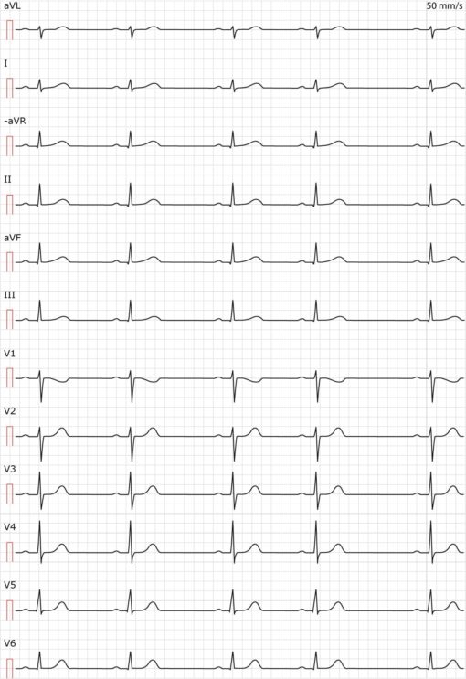 Sinus arrhythmia (respiratory sinus arrhythmia)