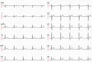Clinical Electrocardiography (ECG) Interpretation