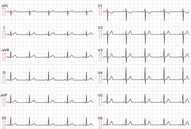 Clinical Electrocardiography (ECG) Interpretation