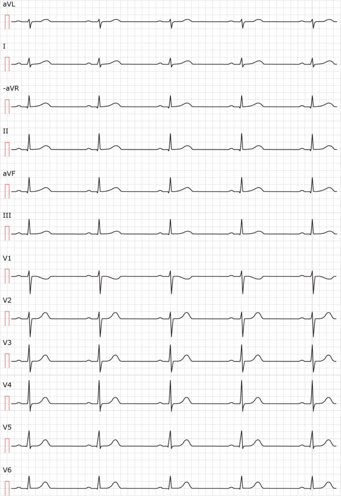 Sinus rhythm: physiology, ECG criteria & clinical implications