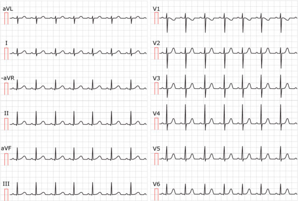Sinus tachycardia & Inappropriate sinus tachycardia