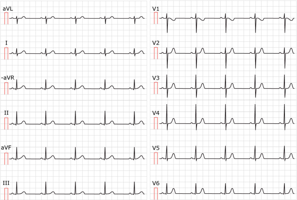 Normal sinus rhythm – The Cardiovascular