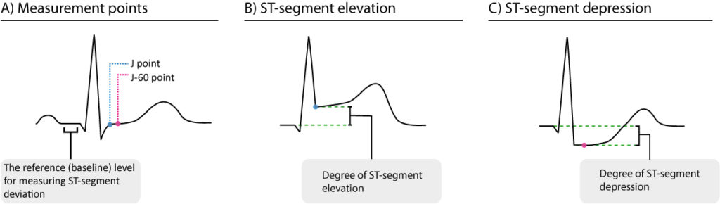 ST-segment deviation (elevation, depression) – The Cardiovascular