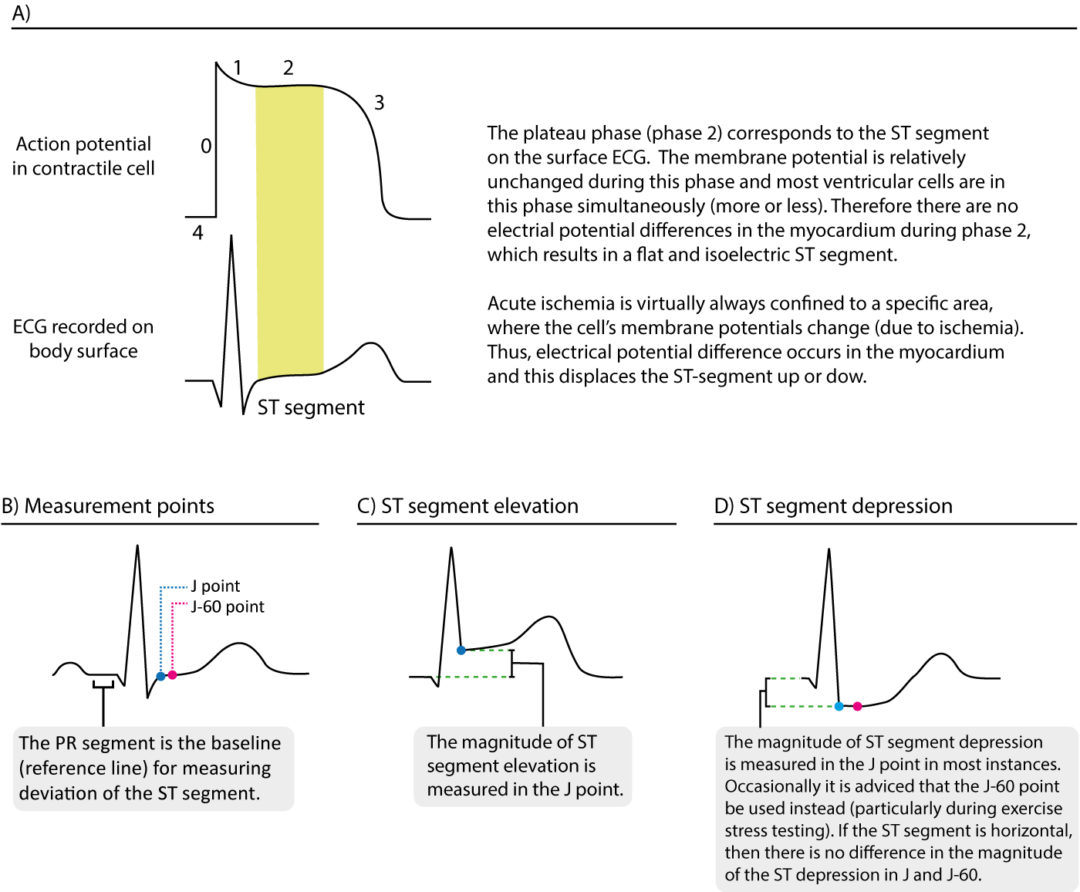 Figure 13. ST segment elevation and depression. – The Cardiovascular