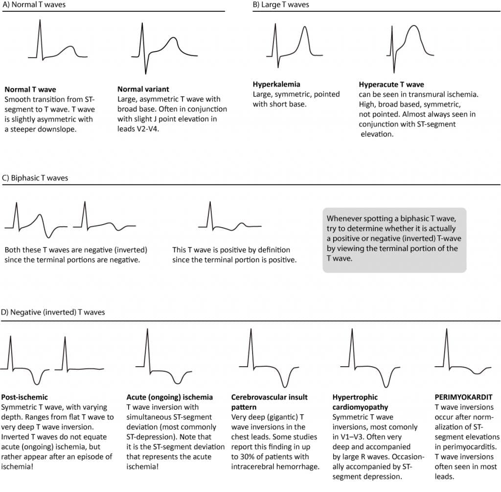 Figur 37. Normal and pathological T-waves. – The Cardiovascular