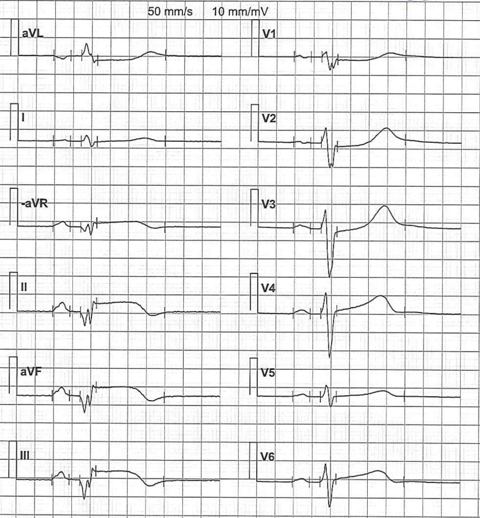 Inferoposterior (inferior and posterior) STEMI – The Cardiovascular