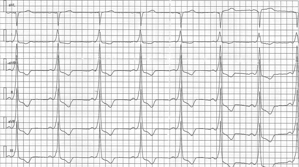 Wolff Parkinson White (WPW, preexcitation syndrome) with delta waves ...