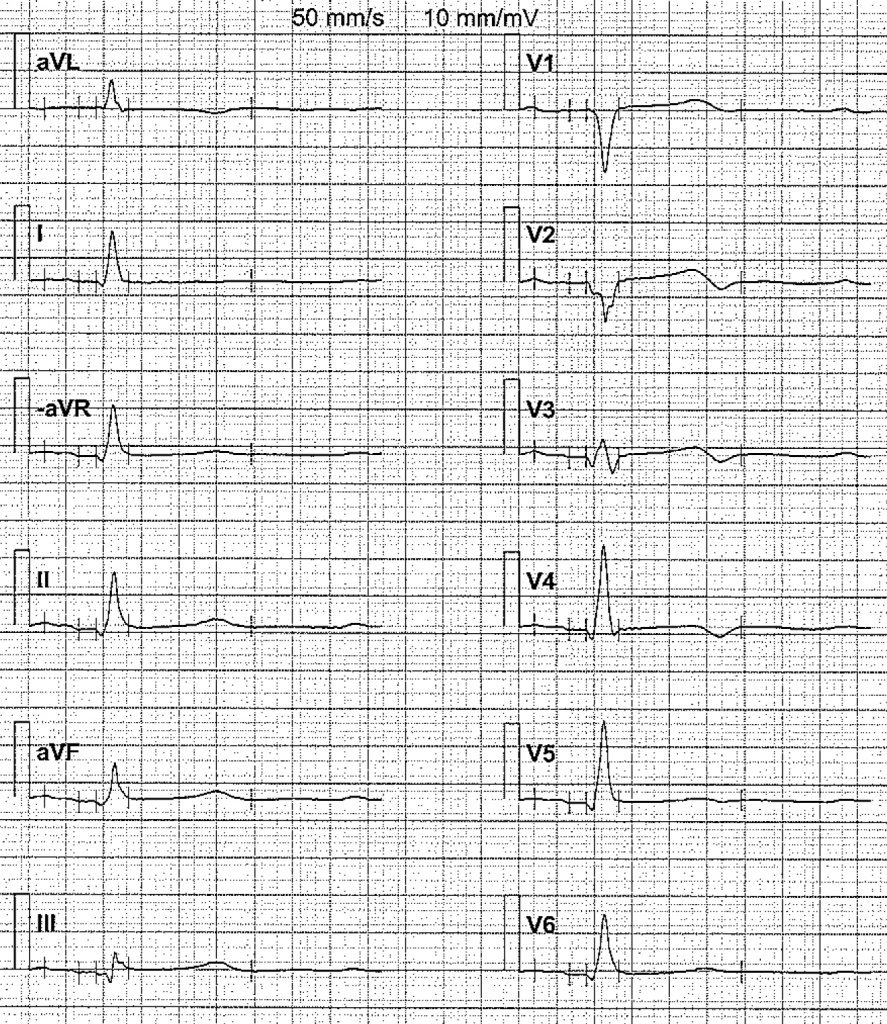Anterior STEMI with late presentation – The Cardiovascular