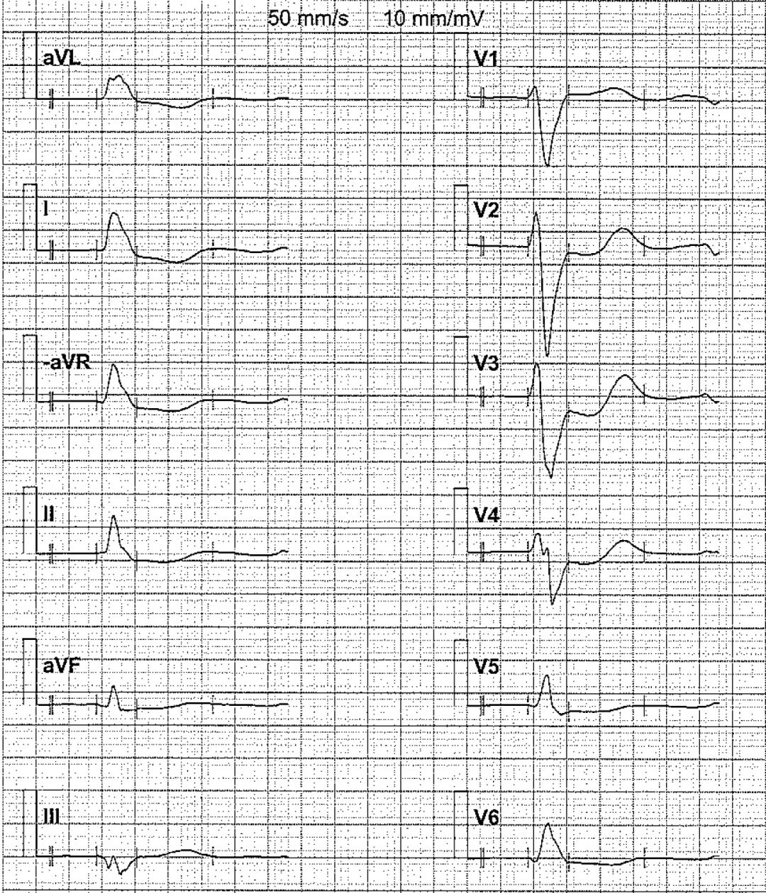 Left bundle branch block with positive Sgarbossa criteria – The ...