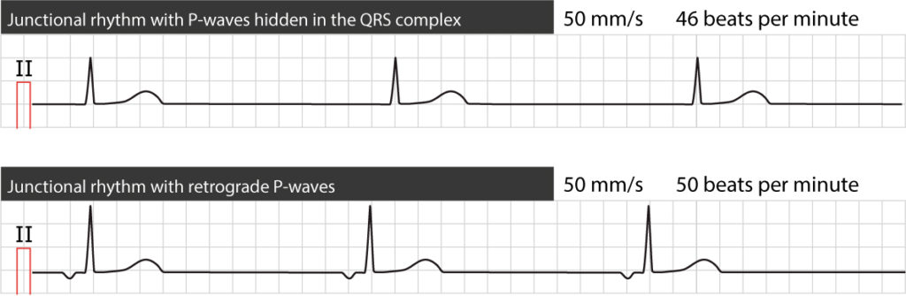 Junctional rhythm (escape rhythm) and junctional tachycardia