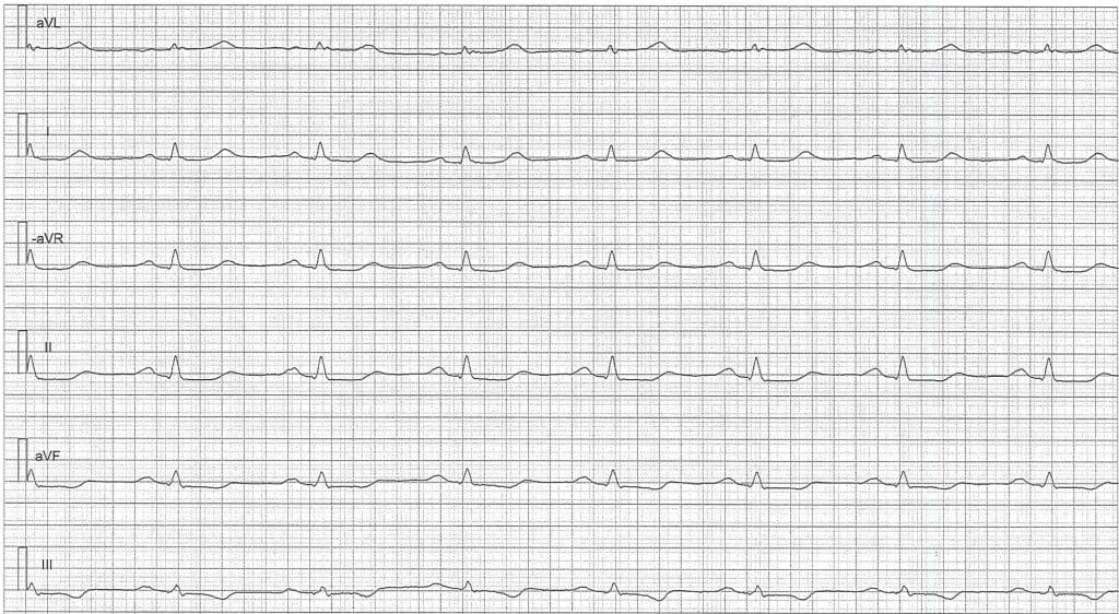 Non ST elevation acute myocardial infarction (NSTEMI) – The Cardiovascular