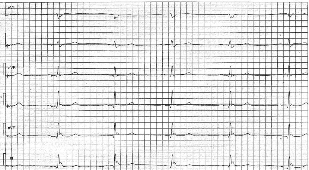 Figure 3. Osborn wave (J wave) in patient with early repolarization ...
