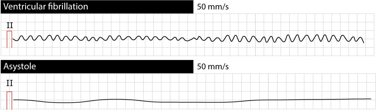 Figure 1. Ventricular fibrillation and asystoli. – The Cardiovascular