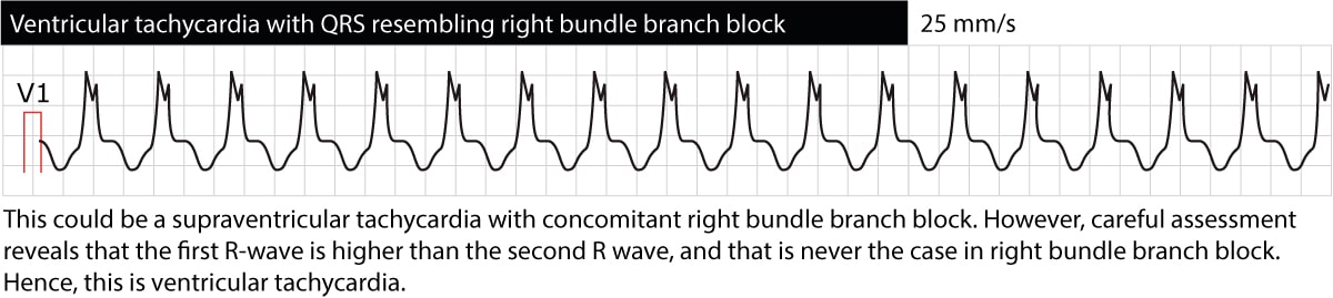 Figure 4. Ventricular tachycardia with right bundle branch block ...