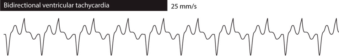 Digoxin - ECG changes, arrhythmias, conduction defects & treatment