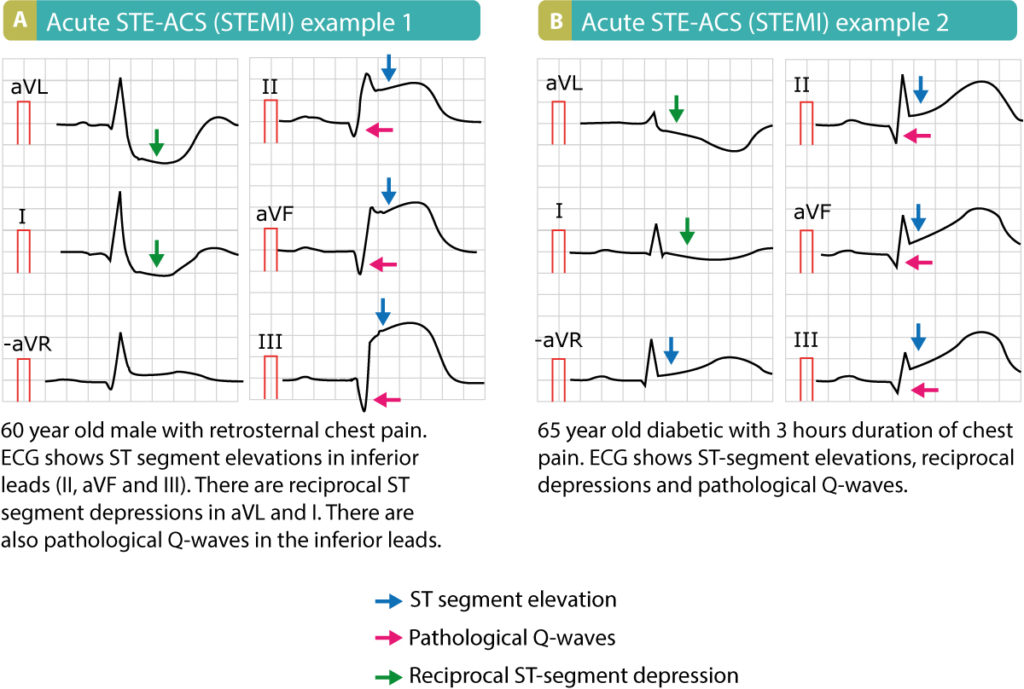 ST segment elevation in acute myocardial ischemia and differential ...