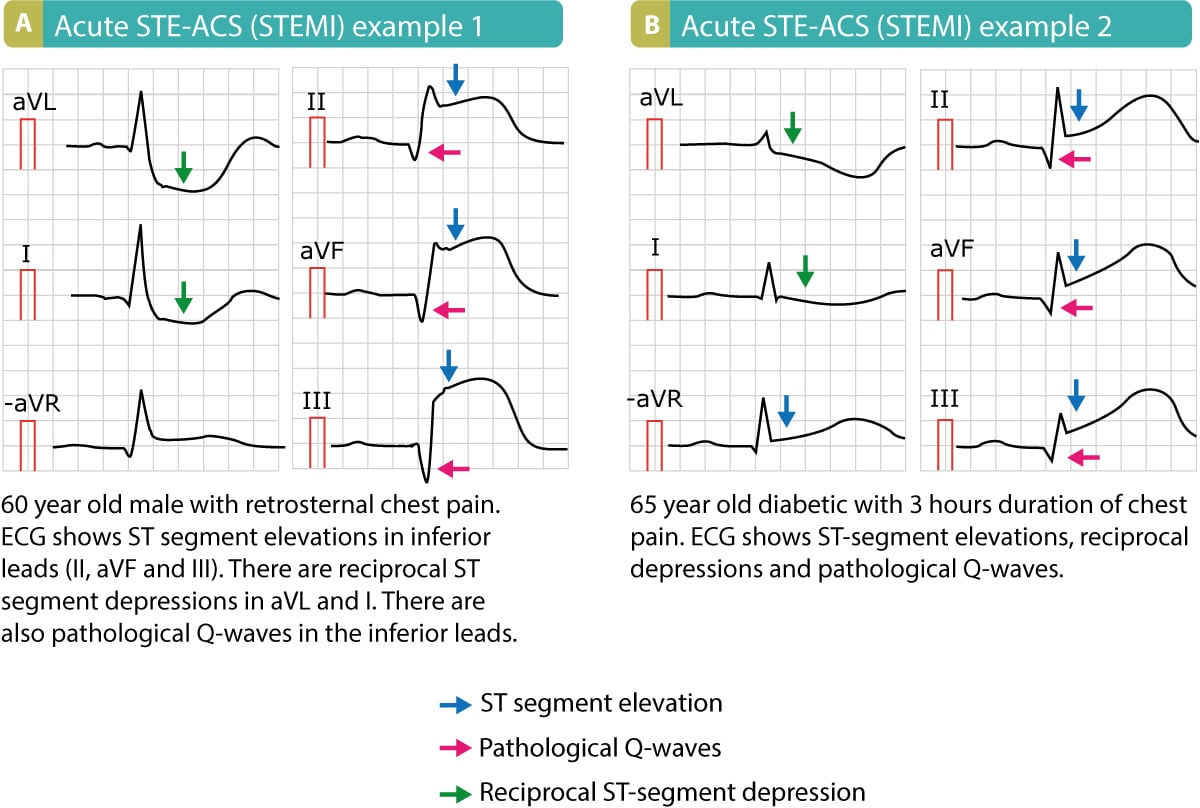 Aberrant Ventricular Conduction The Cardiovascular Aberrant Ventricular Conduction The Cardiovascular