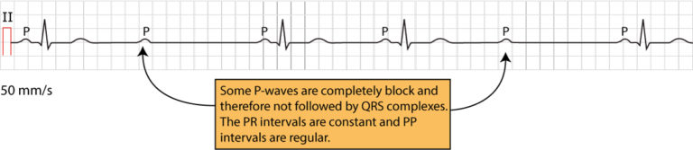 Second-degree AV block: Mobitz type 1 (Wenckebach) & Mobitz type 2 block
