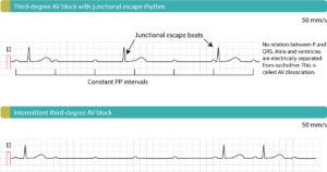 Third-degree AV block (3rd degree AV block, AV block 3, AV block III)