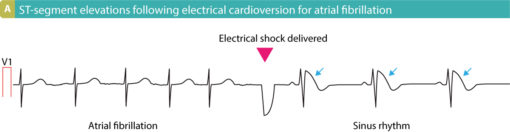 ST segment elevation in acute myocardial ischemia and differential ...
