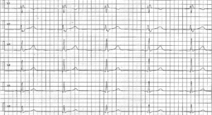 Early repolarization pattern on ECG and early repolarization syndrome