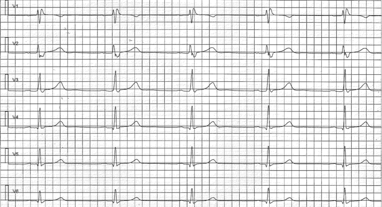 Early repolarization pattern on ECG and early repolarization syndrome