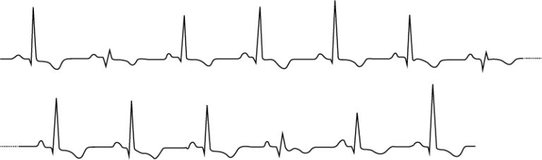 Eletrical alternans: the ECG in pericardial effusion & cardiac tamponade