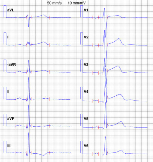 ECG J wave syndromes: hypothermia, early repolarization, hypercalcemia ...