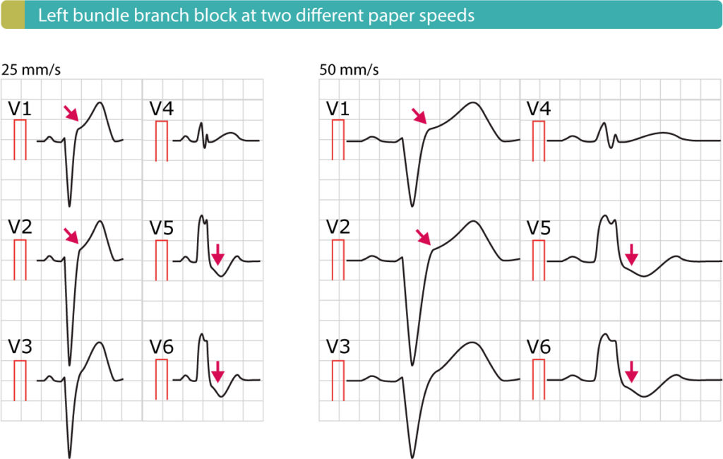 ST segment elevation in acute myocardial ischemia and differential diagnoses